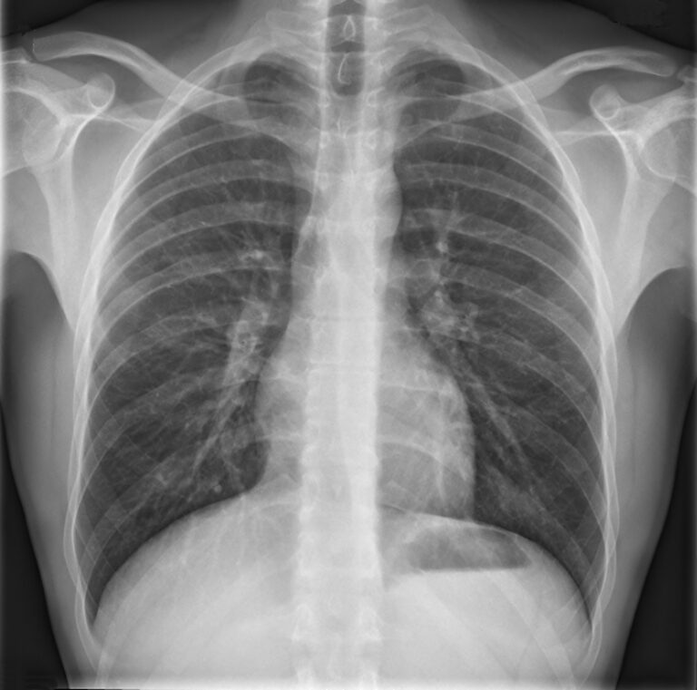 Chest X-Ray - Buffalo Breathe Now